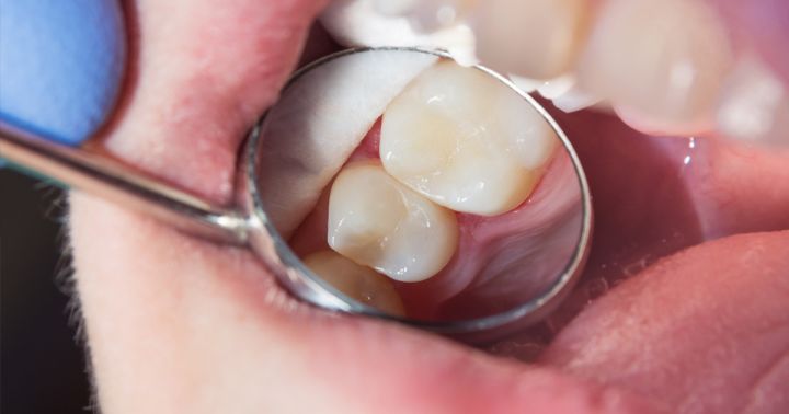 What Do Cavities Look Like Before The Treatment
