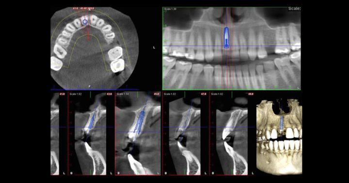 I’ve Broken My Front Tooth, Now What?! | Mint Hill Dentistry