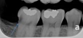 Wisdom Teeth 101 | Mint Hill Dentistry | Charlotte NC Dentist